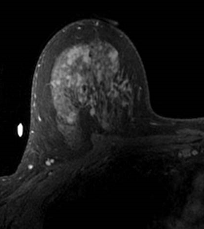 MRI Clumped NME - Breast Rads